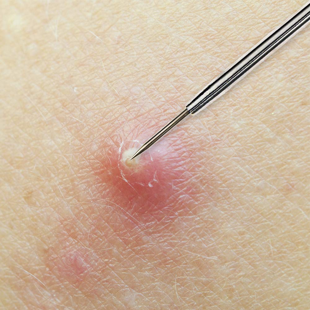 Blackhead Remover Tool, Pimple Popper Tool Kit, Blackhead Extractor ...